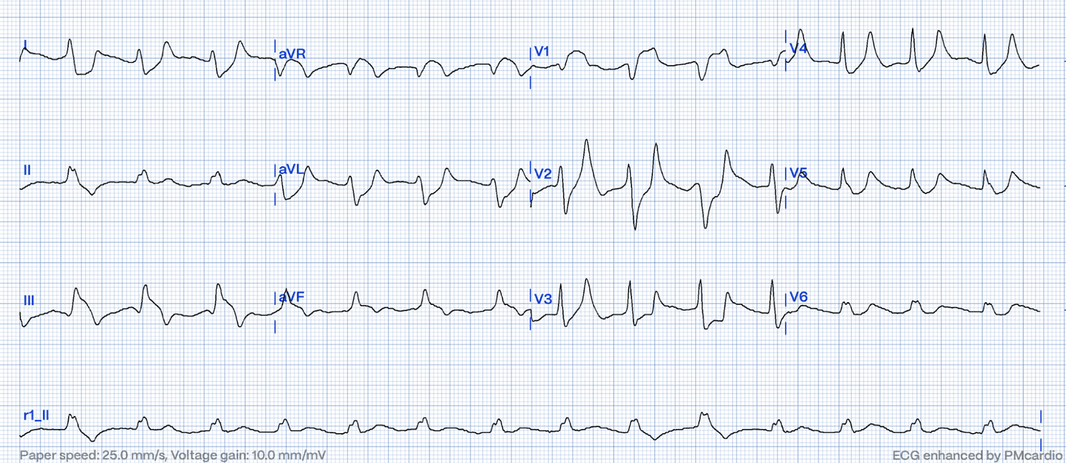 STEMI Mimics: Spot Subtle Impostors of Myocardial Infarction