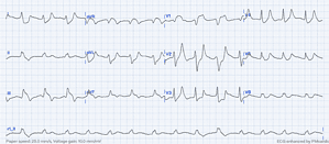 STEMI Mimics: Spot Subtle Impostors of Myocardial Infarction