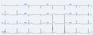 STEMI Mimics: Spot Subtle Impostors of Myocardial Infarction
