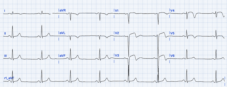 STEMI Mimics: Spot Subtle Impostors of Myocardial Infarction
