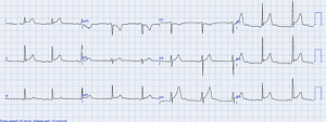 STEMI Mimics: Spot Subtle Impostors of Myocardial Infarction