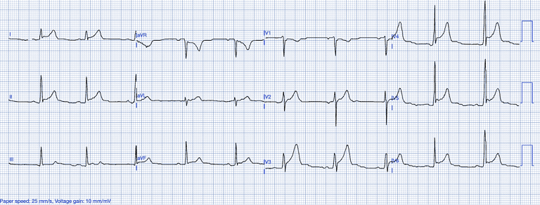STEMI Mimics: Spot Subtle Impostors of Myocardial Infarction