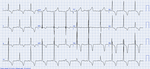 STEMI Mimics: Spot Subtle Impostors of Myocardial Infarction