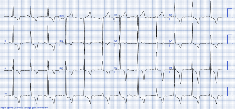 STEMI Mimics: Spot Subtle Impostors of Myocardial Infarction