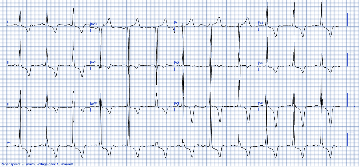 STEMI Mimics: Spot Subtle Impostors of Myocardial Infarction