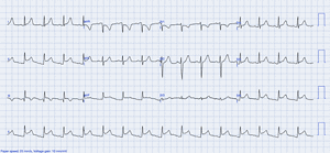 STEMI Mimics: Spot Subtle Impostors of Myocardial Infarction