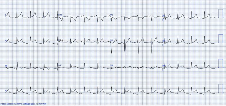 STEMI Mimics: Spot Subtle Impostors of Myocardial Infarction