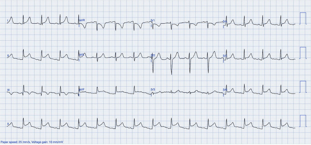 STEMI Mimics: Spot Subtle Impostors of Myocardial Infarction