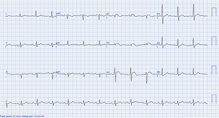 STEMI Mimics: Spot Subtle Impostors of Myocardial Infarction