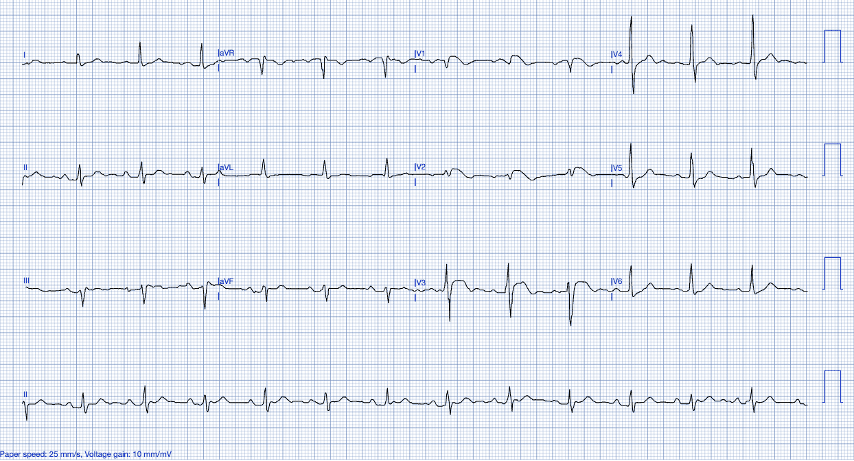 STEMI Mimics: Spot Subtle Impostors of Myocardial Infarction