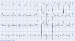 STEMI Mimics: Spot Subtle Impostors of Myocardial Infarction