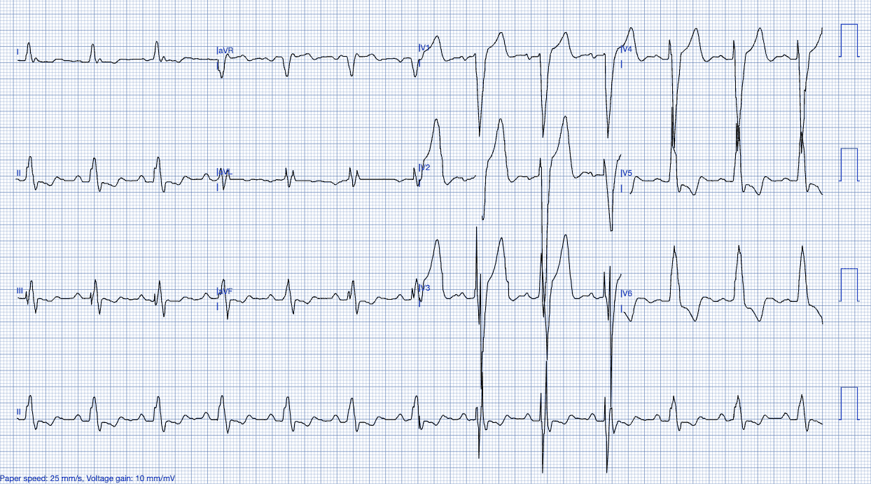 STEMI Mimics: Spot Subtle Impostors of Myocardial Infarction