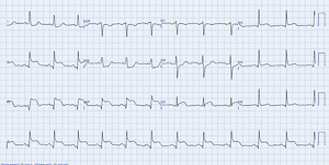STEMI ECG Criteria: Key Insights into Ischemic ST-Elevation Patterns