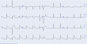 STEMI ECG Criteria: Key Insights into Ischemic ST-Elevation Patterns