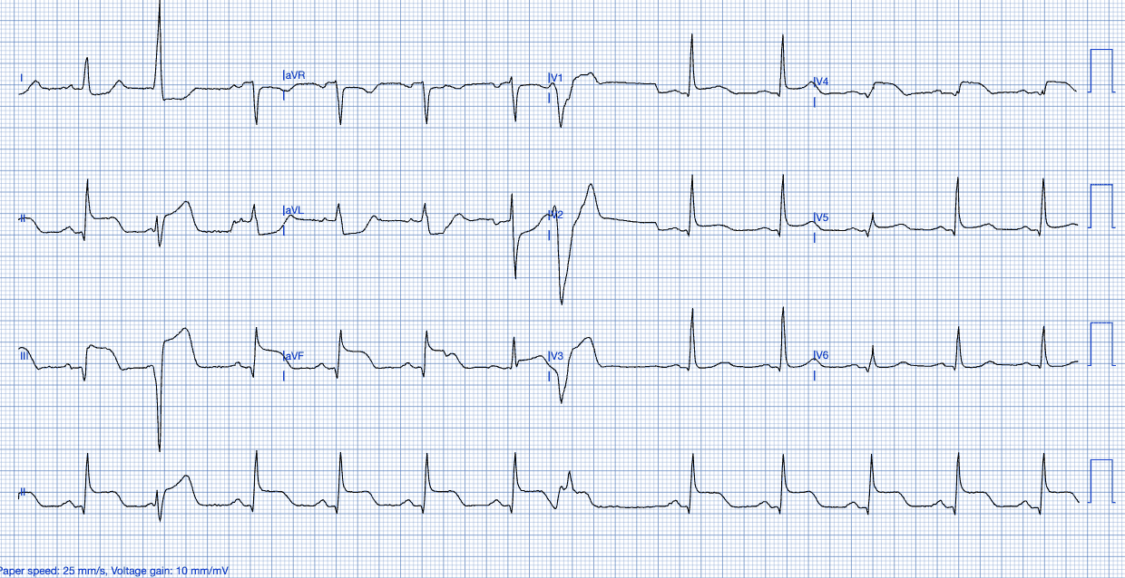 STEMI ECG Criteria: Key Insights into Ischemic ST-Elevation Patterns