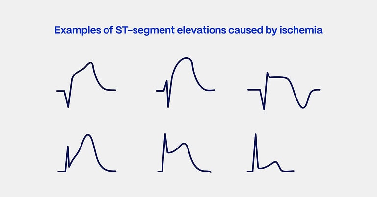 STEMI ECG Criteria: Key Insights into Ischemic ST-Elevation Patterns