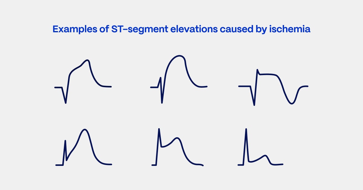 STEMI ECG Criteria: Key Insights into Ischemic ST-Elevation Patterns