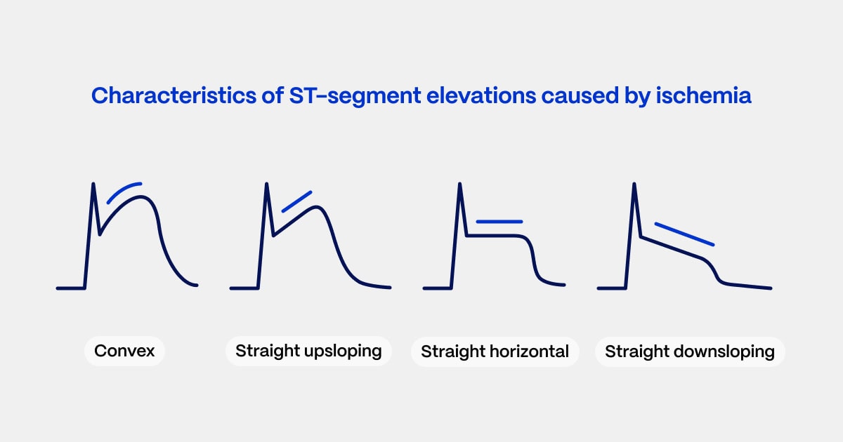 Stemi Ecg Criteria Key Insights Into Ischemic St Elevation Patterns