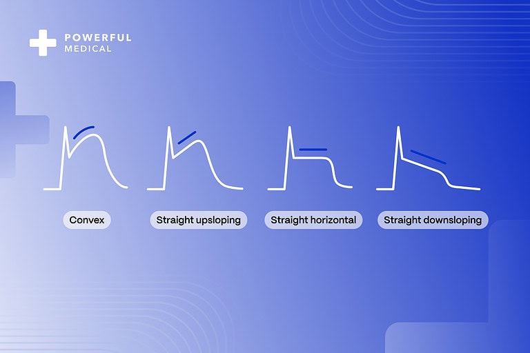 STEMI ECG Criteria: Key Insights into Ischemic ST-Elevation Patterns