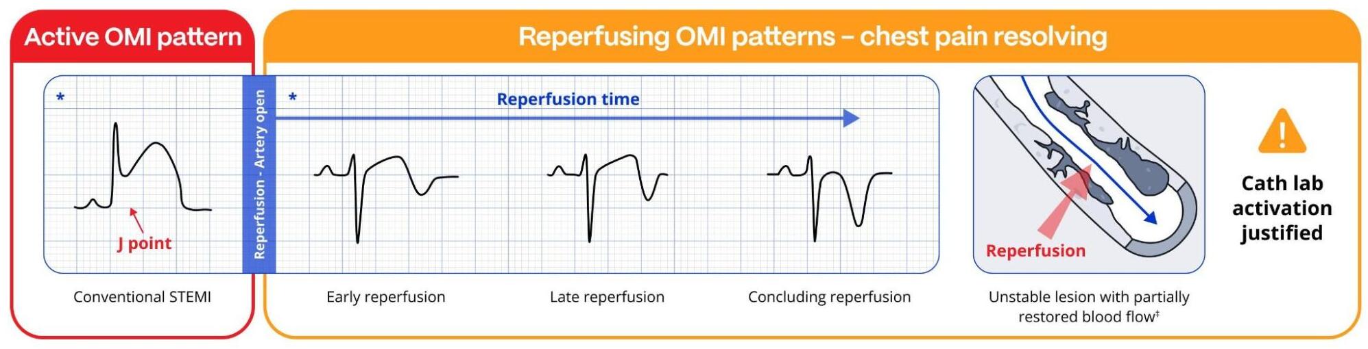Advanced STEMI Detection and Improved Cath Lab Activation Through ...