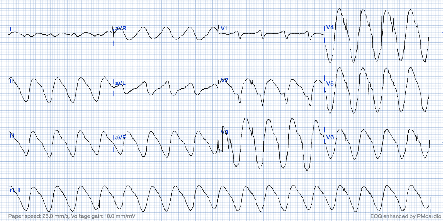 Unmasking Hyperkalemia: Highlighting Critical ECG Changes