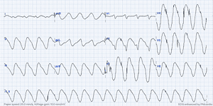 Unmasking Hyperkalemia: Highlighting Critical ECG Changes