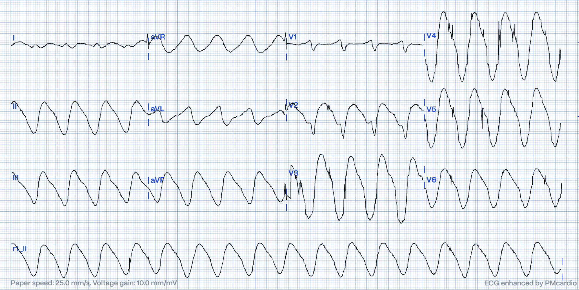 Unmasking Hyperkalemia: Highlighting Critical ECG Changes