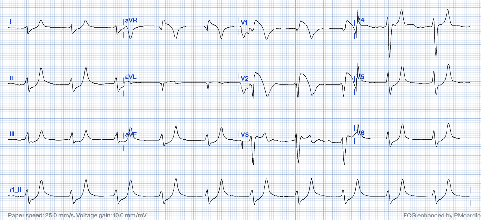 Unmasking Hyperkalemia: Highlighting Critical ECG Changes