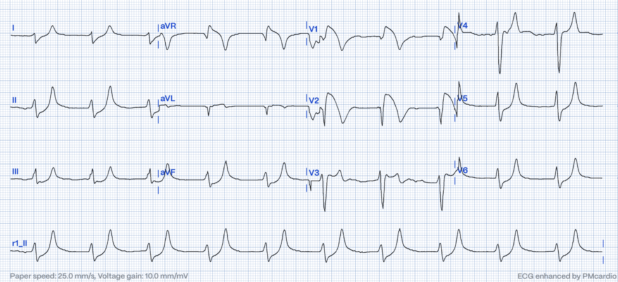 Unmasking Hyperkalemia: Highlighting Critical ECG Changes