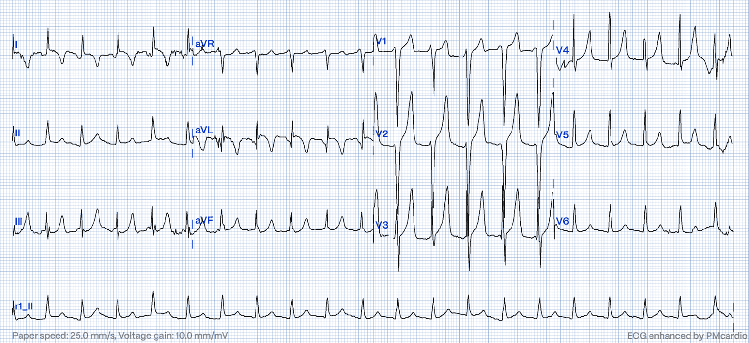 Unmasking Hyperkalemia: Highlighting Critical ECG Changes