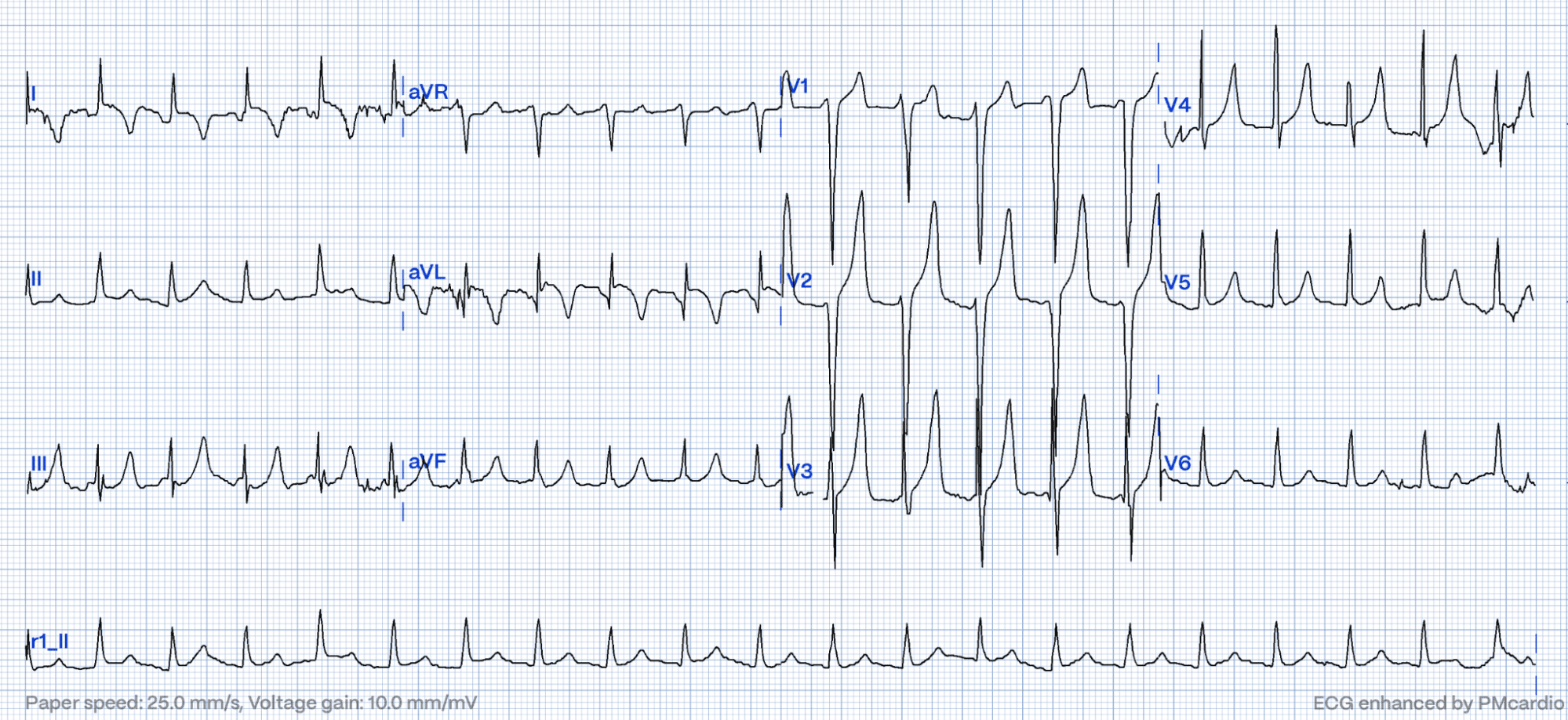 Unmasking Hyperkalemia: Highlighting Critical ECG Changes
