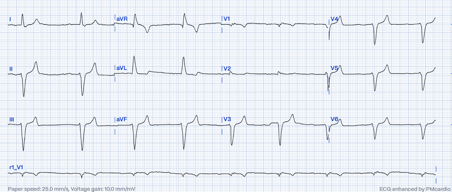Unmasking Hyperkalemia: Highlighting Critical ECG Changes