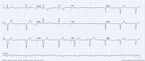 Unmasking Hyperkalemia: Highlighting Critical ECG Changes