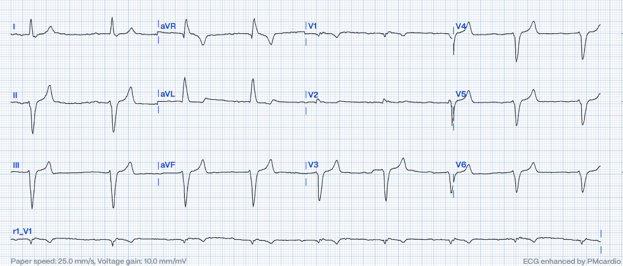 Unmasking Hyperkalemia: Highlighting Critical ECG Changes