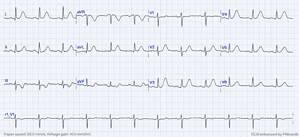 Unmasking Hyperkalemia: Highlighting Critical ECG Changes