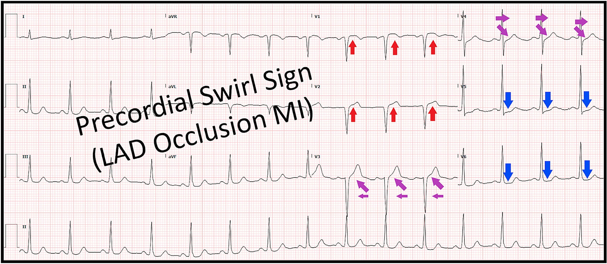 Precordial Swirl Sign: A New ECG Pattern of Left Anterior Descending ...
