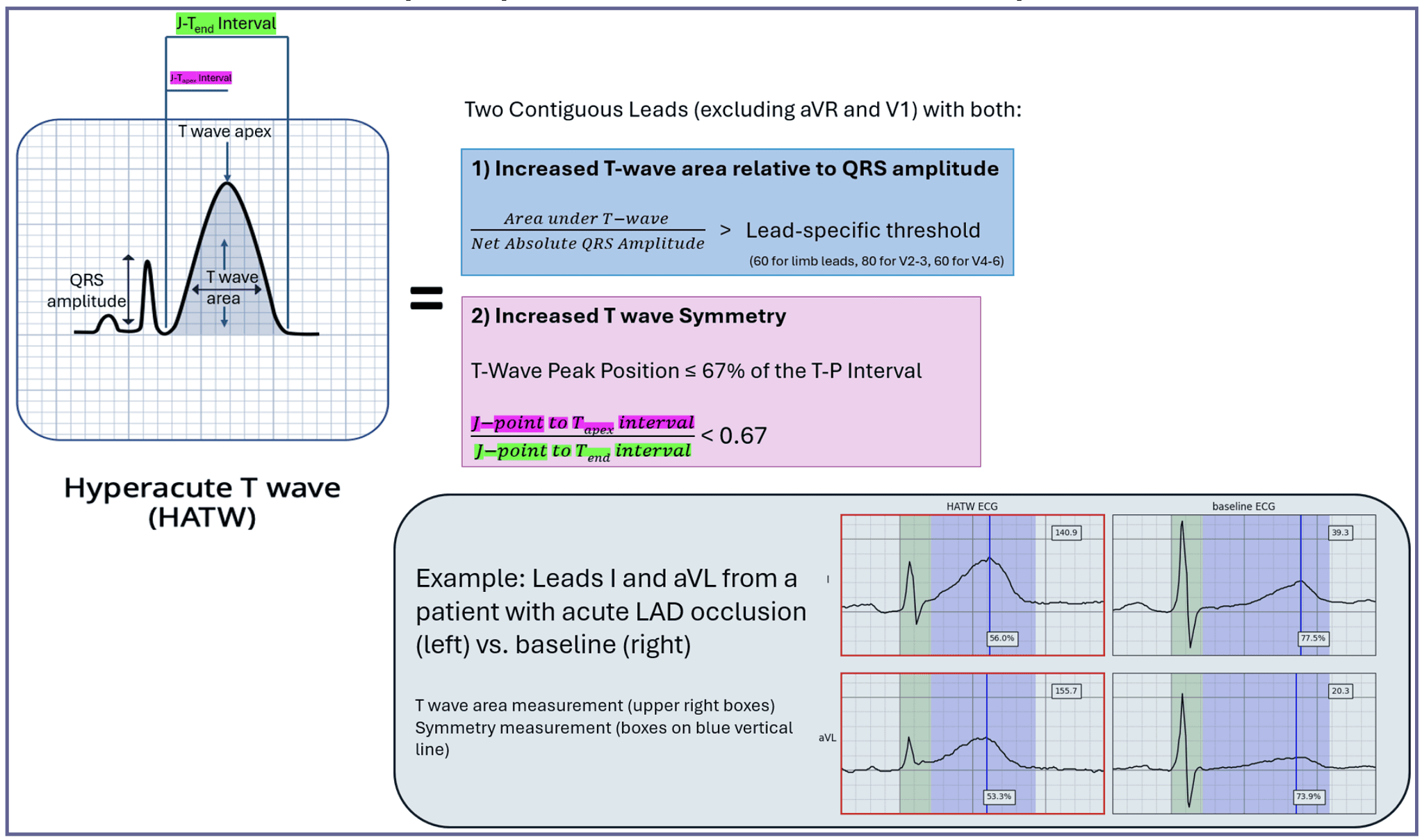 First Objective Definition of Hyperacute T-waves as a ST-segment ...