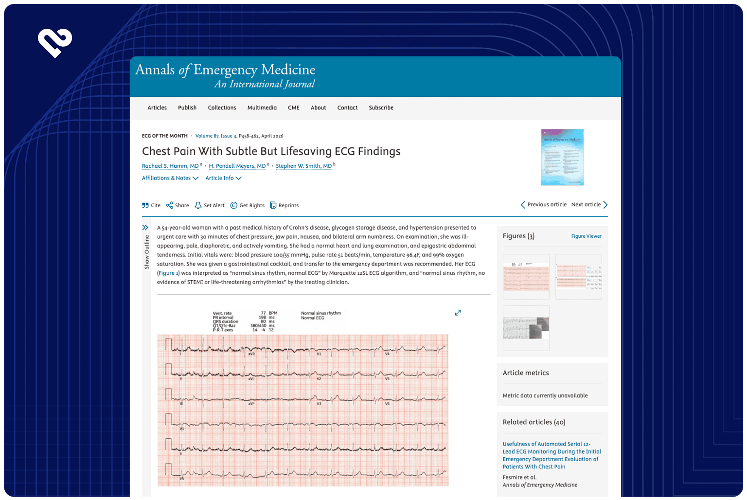 Precordial Swirl Sign: A New ECG Pattern of Left Anterior Descending ...